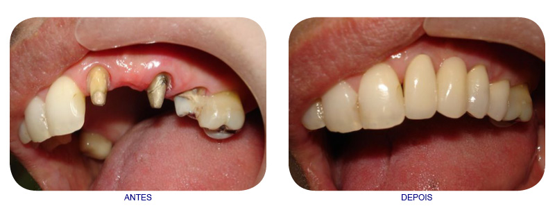 Prótese Parcial Fixa; Ponte Fixa; Dentadura Parcial Fixa; Pôntico